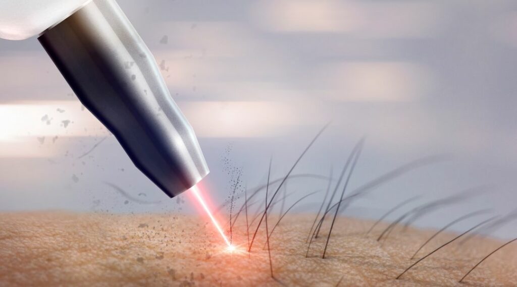 Is Laser Hair Removal Bad For You? Regeneration Medical Spa